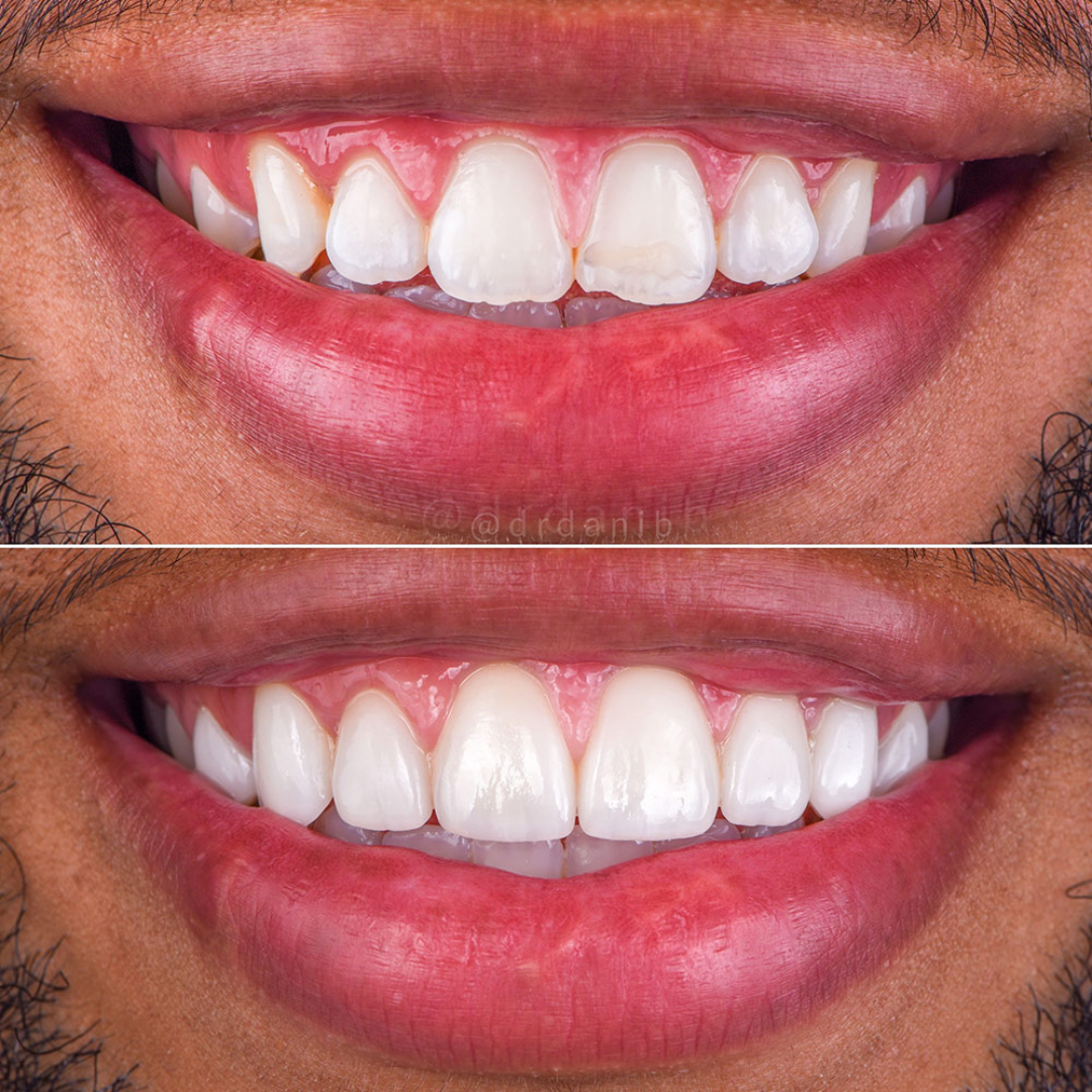 5 Reasons to Choose Laser Dentistry for Your Next Dental Visit - DR. DANIB