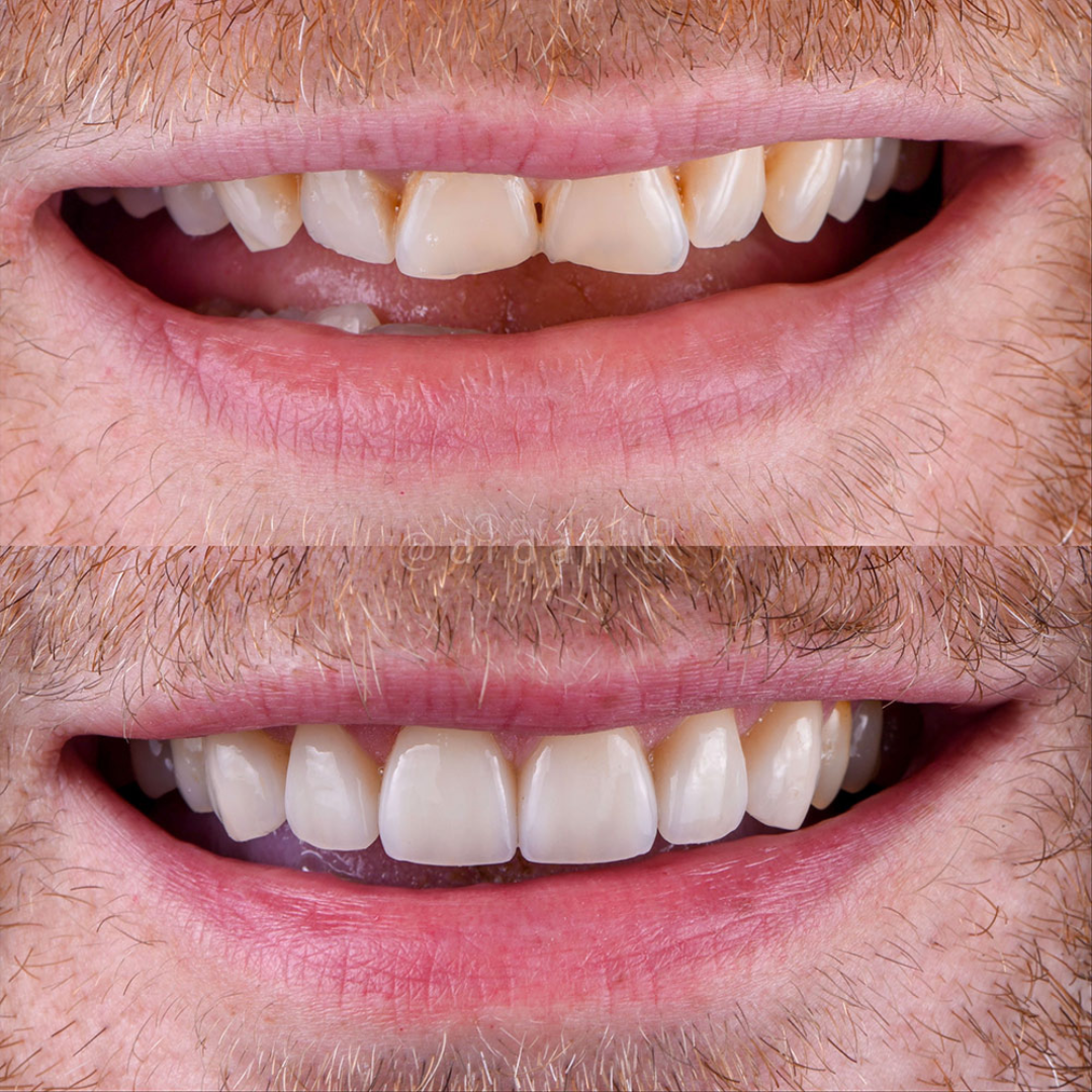 Top 9 Reasons to Choose Minimal Prep Veneers vs Traditional Veneers ...