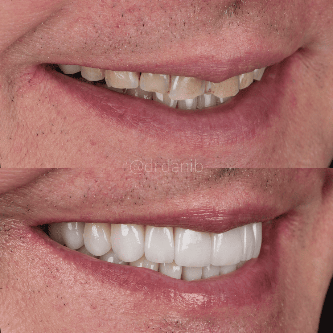 Facial Rejuvenation Through Dentistry: How All-on-X Implants Enhance ...